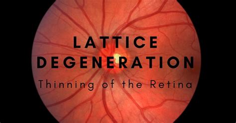 Lattice Degeneration Take A Look Into Causes Symptoms And Eye Exam Importance