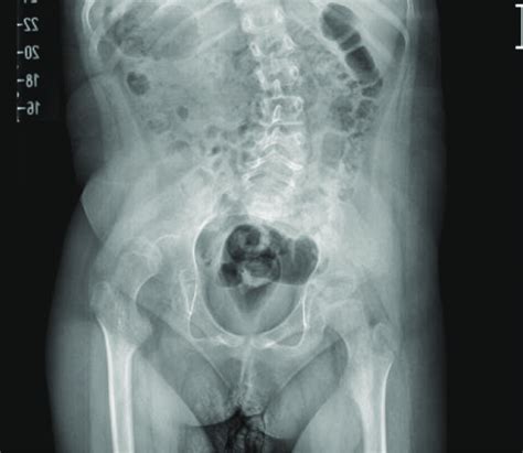 Pelvic X Ray Subluxation Of Left Hip And Lumbar Scoliosis Download Scientific Diagram