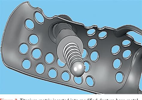 Figure 1 From Finite Element Analysis Of Implant‐assisted Removable Partial Dentures Framework