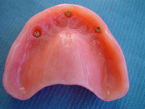 Implant Dentures Complete Northland Prosthodontics Northland Denture Specialist Whangarei