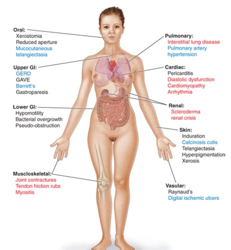 Systemic Sclerosis Aka Scleroderma Flashcards Quizlet