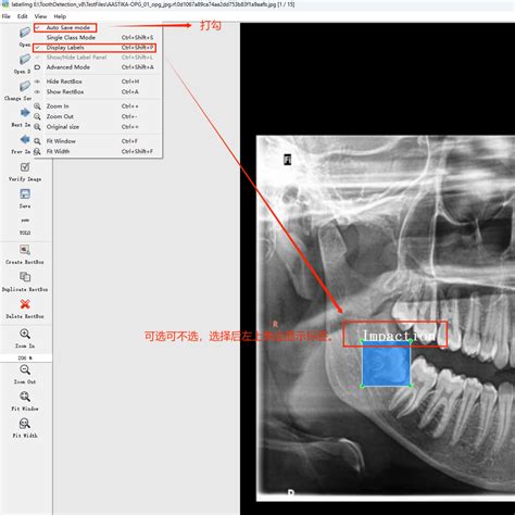 基于yolov8深度学习的智慧医疗口腔牙齿ct影像检测系统pyqt5界面数据集训练代码口腔ct数据集 Csdn博客