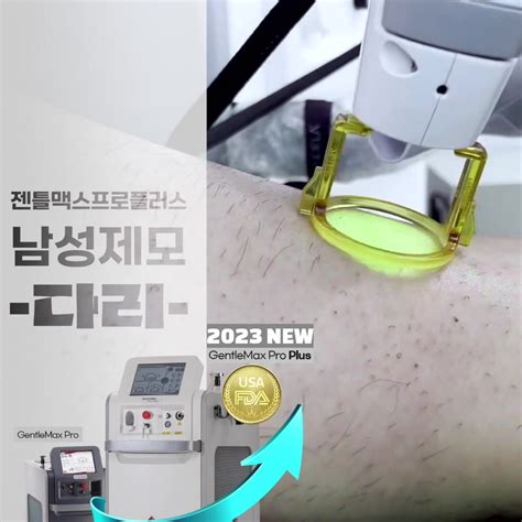 프리미엄 제모 레이저 젠틀맥스 프로 플러스를 이용한 레이저 제모 는 젠틀맥스프로 와는 달리 더욱 빠르고 더욱 안정적이고 더욱 세밀하고 더욱 강력한 시술이 가능한