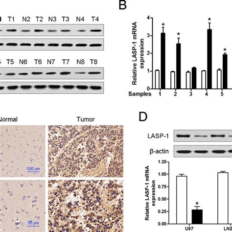 Levels Of Lasp1 Expression In Glioma Tissue Samples And Cells A