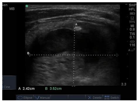 Normal Left Thyroid Ultrasound