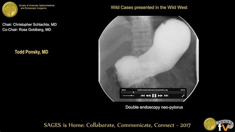 Double Endoscopic Recanalization Following Pyloric Exclusion For