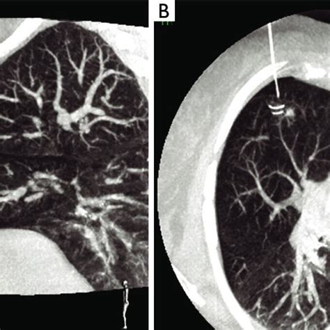 Middle Lobe Nodule Wedge Resection Planned Having The Horizontal Download Scientific Diagram