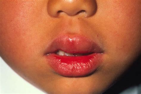 Food Allergies Food Allergy Rashes Allergic Reaction On Tongue