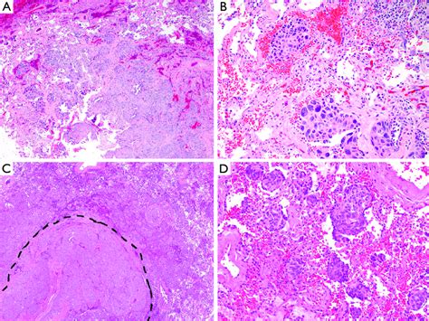 Tumor Spread Through Air Spaces Stas In Other Histologic Subtypes An Download Scientific