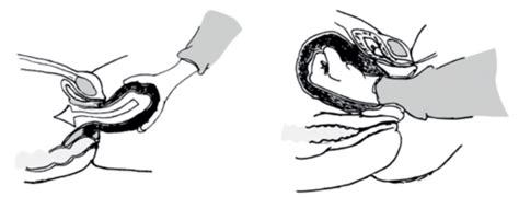 Abnormal Labour Flashcards Quizlet