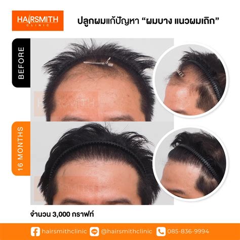 ปลูกผม Dhi กับ Fue ต่างกันอย่างไร เลือกปลูกผมวิธีไหนดี