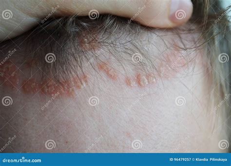 Psoriasis Eczema Dermatitis Along The Hair Growth Line On The