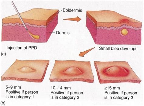 How To Read Tb Skin Test Pictures