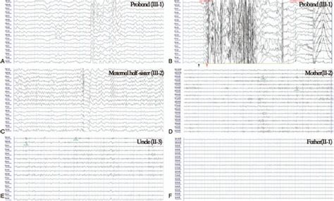 Novel SCN A Mutation In A Family Associated With Juvenile Onset