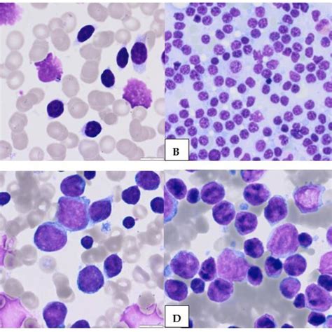 Morphological Features Of Classic Ab And Large Cd Cll Cells