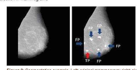 Figure 3 From Assessment Of A Novel Mass Detection Algorithm In