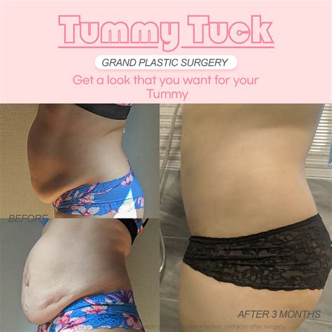 No Need To Hide Your Saggy Grand Plastic Surgery Korea