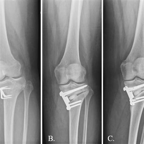 Revision Osteotomy For Overcorrection After Medial Closing Wedge High