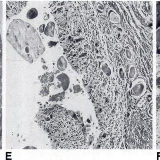 A Radiograph Of Right Hip Shows Ovoid Lucency In Proximal Femur Download Scientific Diagram