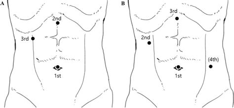 Laparoscopic Working Port Locations For Laparoscopic Cholecystectomy A Download Scientific