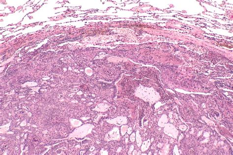 Glandular Squamous Cells At Louis Tillmon Blog