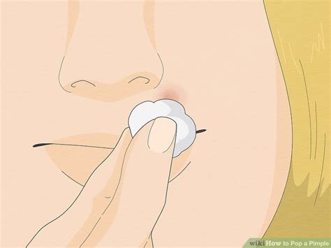 Simple Ways To Pop A Pimple WikiHow