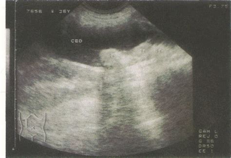 第三节 胆管结石 腹部彩色超声诊断 医学