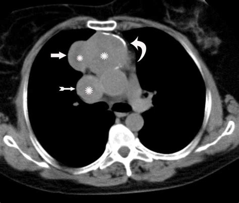 A 53 Year Old Woman With Invasive Thymoma With Extensive Intraluminal