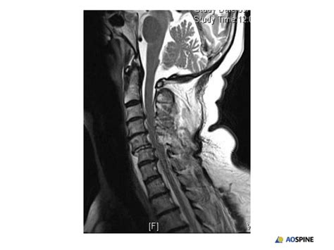 Unifacet Dislocation Mri Ppt