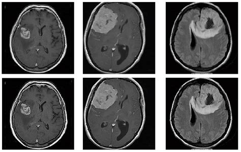 Pre Processed Brain Images With Brain Tumor On Mr Images Download