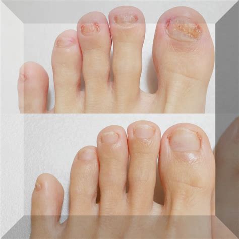30대 여자 발톱무좀 치료기 새끼발톱 엄지 고루번진 증상 이야기 네이버 블로그