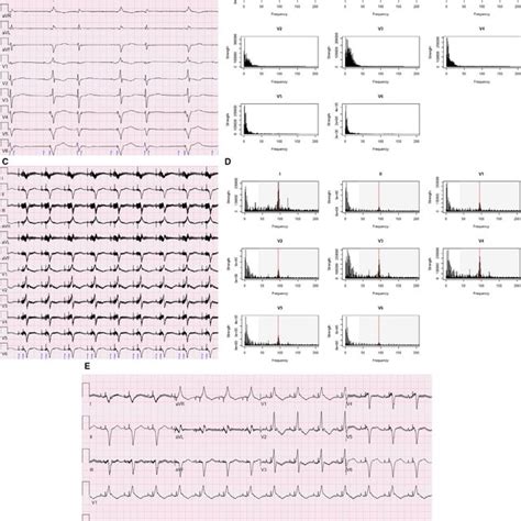 Age Sex And Lvad Settings For Included Patients Download Scientific