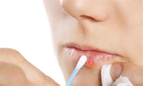 Valacyclovir Vs Acyclovir A Comprehensive Comparison