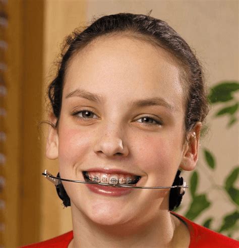 Orthodontic Headgear Straight