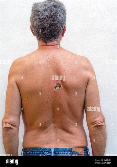 Electrical Shock Entry And Exit Wounds And Burns In 50s Adult Caucasian