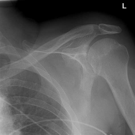 Acromial Khám Phá Thuật Ngữ Y Học Về Mỏm Cùng Vai