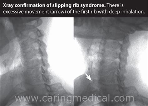 Slipping Rib Syndrome