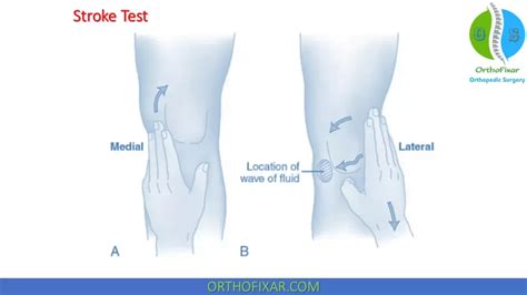 Knee Effusion Tests Explained Easily Orthofixar