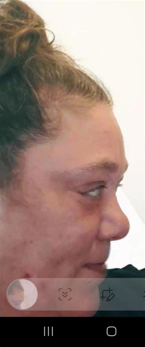 Jenn Was Really Trying To Hide Those Pick Marks This Morning But She Slipped Up A Few Times R