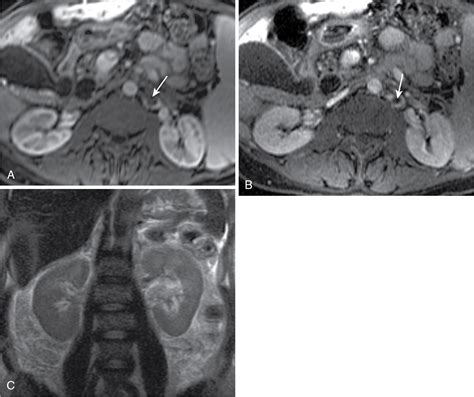 Diffuse Renal Parenchymal Disorders Radiology Key