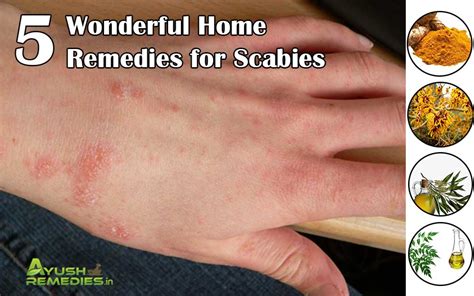 Treatment For Mites Scabies Scabies Mites Kgexp