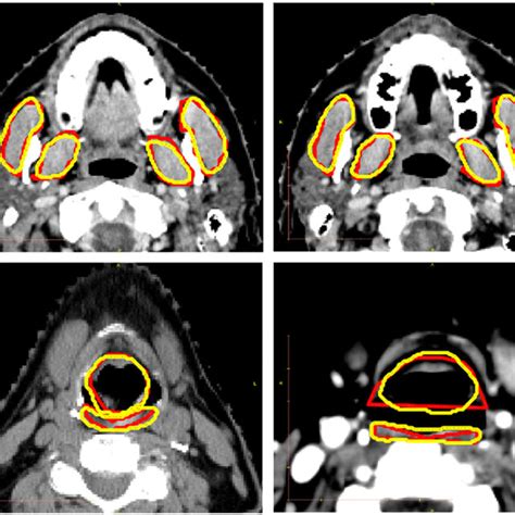Auto Segmentation Results For Chewing Structures Row 1 And Swallowing Download Scientific