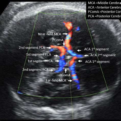 PDF ISUOG Practice Guidelines Updated Use Of Doppler Velocimetry