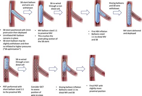 Evolution Of The Crush Technique For Bifurcation Stenting Jacc