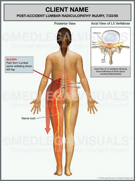 Diagnosis And Treatment Of Lumbar Radiculopathy