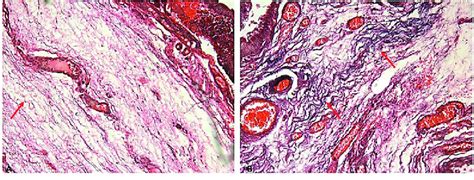 Verhoeff Stained Sections Showing Elastosis Of Different Grades Red Download Scientific