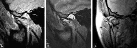 Mr Imaging Assessment Of Temporomandibular Joint Soft Tissue Injuries