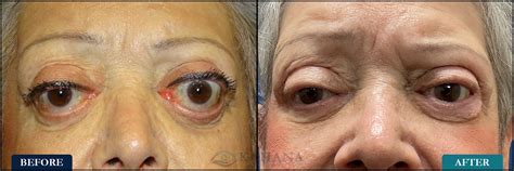 Thyroid Eye Disease Upper Eyelid Surgery