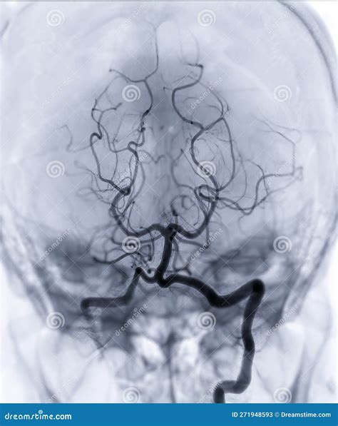 Cerebral Angiography Image From Fluoroscopy In Intervention Radiology