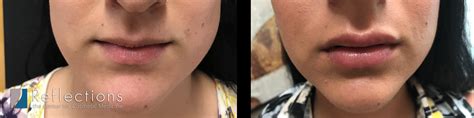 1 Syringe Juvederm For Young Italian Woman Before And After Photos New